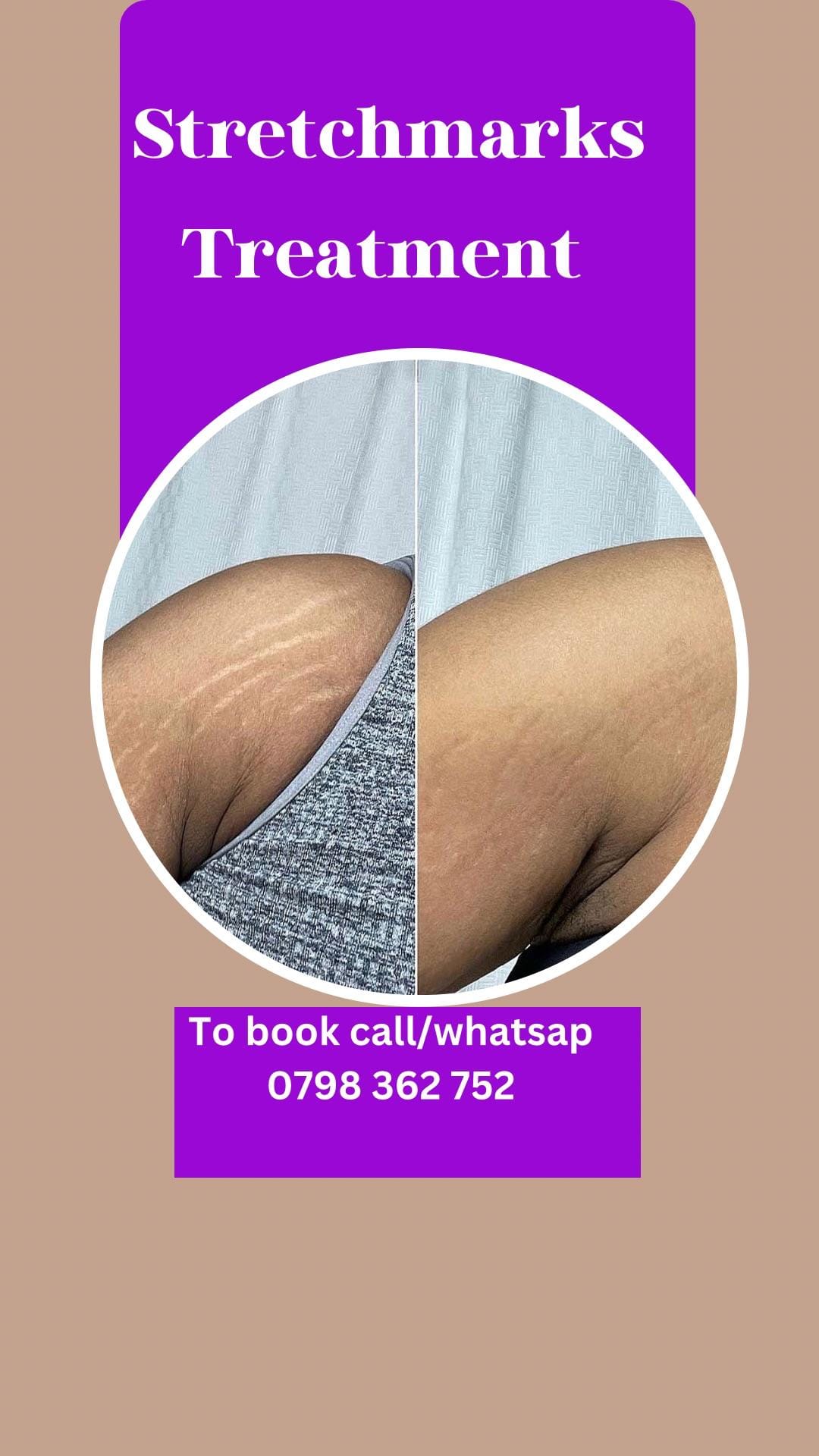 Keloids, Stretchmarks, Acne , Ozempic, Weightloss and Scars in Nairobi - Afya Core Skin and ...